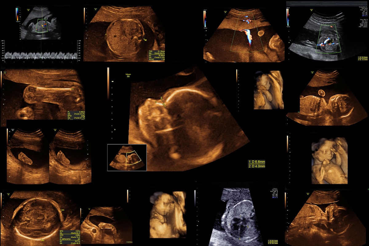 Pro-life doctors refute ‘blatant misinformation’ on prenatal heartbeats ...
