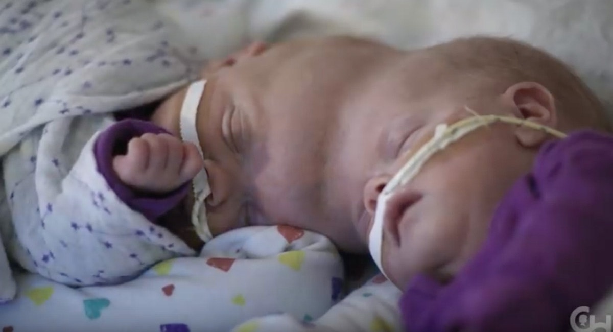 Conjoined twins Abby and Erin Delaney, now two, have beaten all the ...