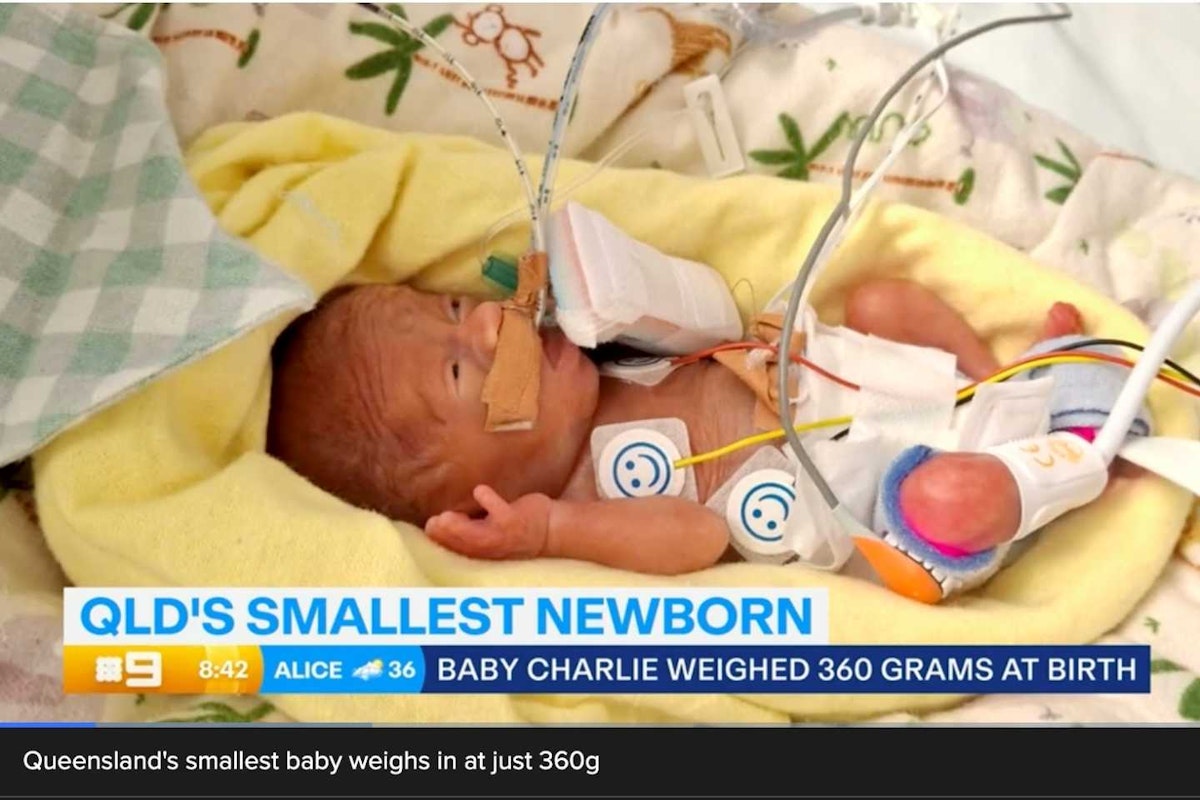 Queensland’s smallest baby born weighing just 360 grams | Live Action